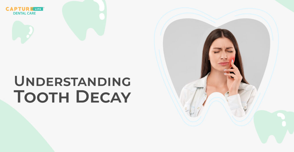 Identifying and Preventing Tooth Decay: Your Comprehensive Guide ...