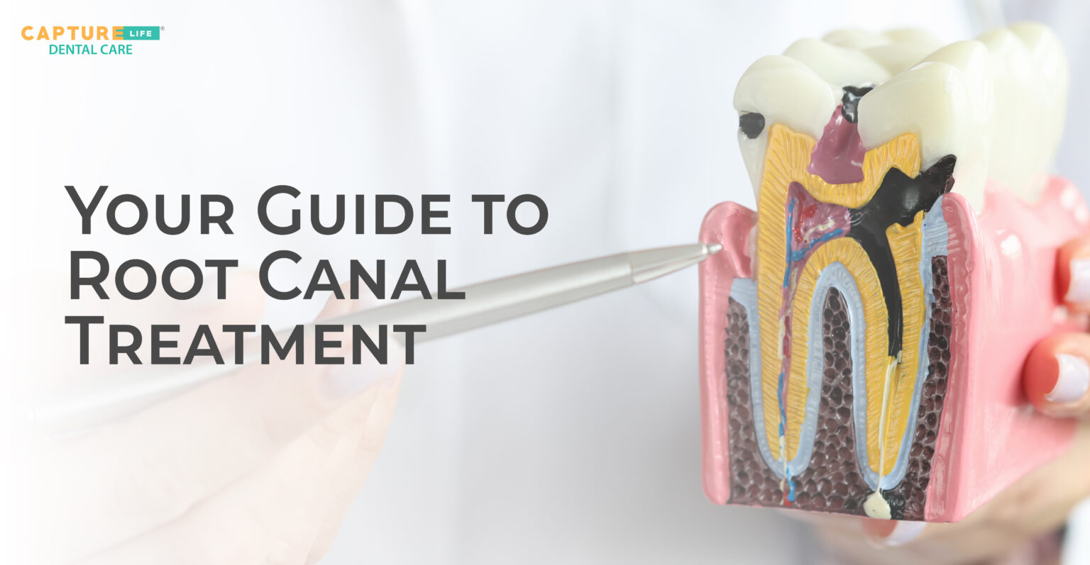 Root Canal Treatment: Your Complete Guide to Understanding and Experiencing This Essential ...